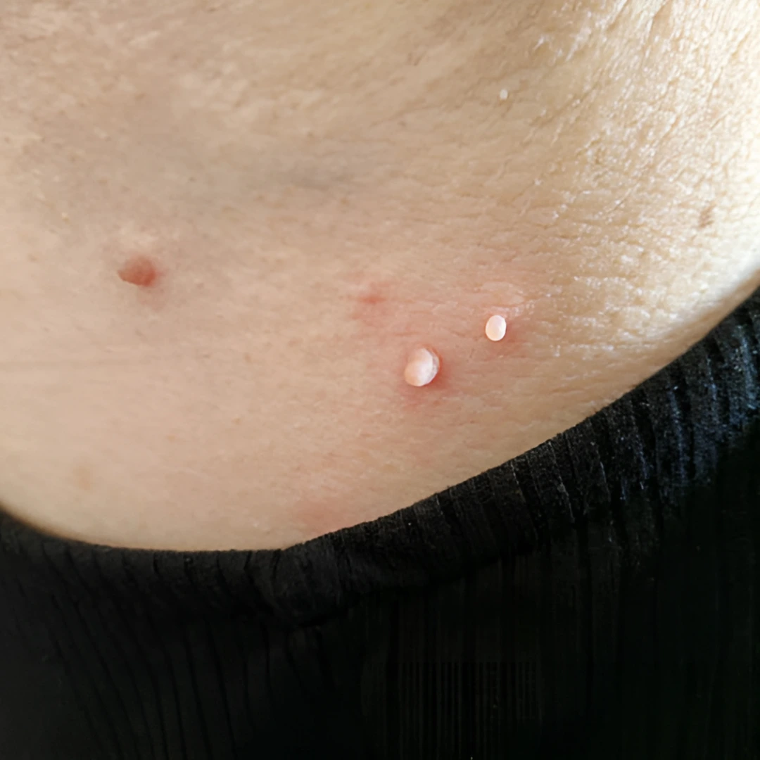 Types of Skin Tags: Identification & When to See a Doctor.