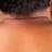 6 Ways to Remove Black Neck: Remedies, Treatments, Prevention